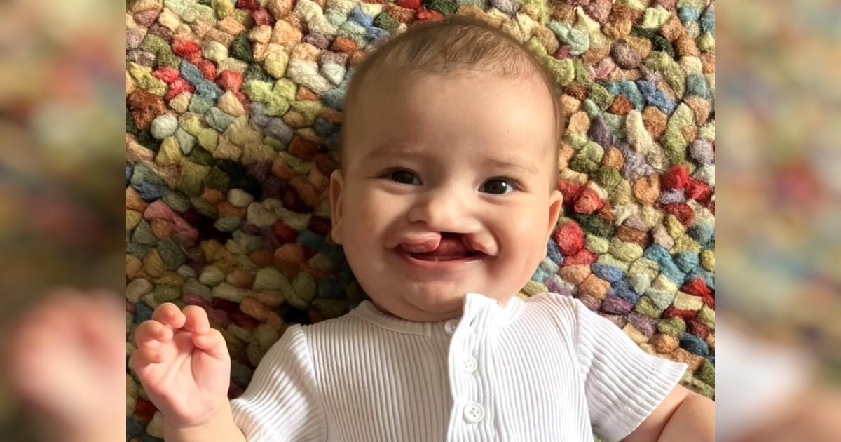 Creating a lifetime of smiles for the 1 in 700 cleft babies like Bowie ...