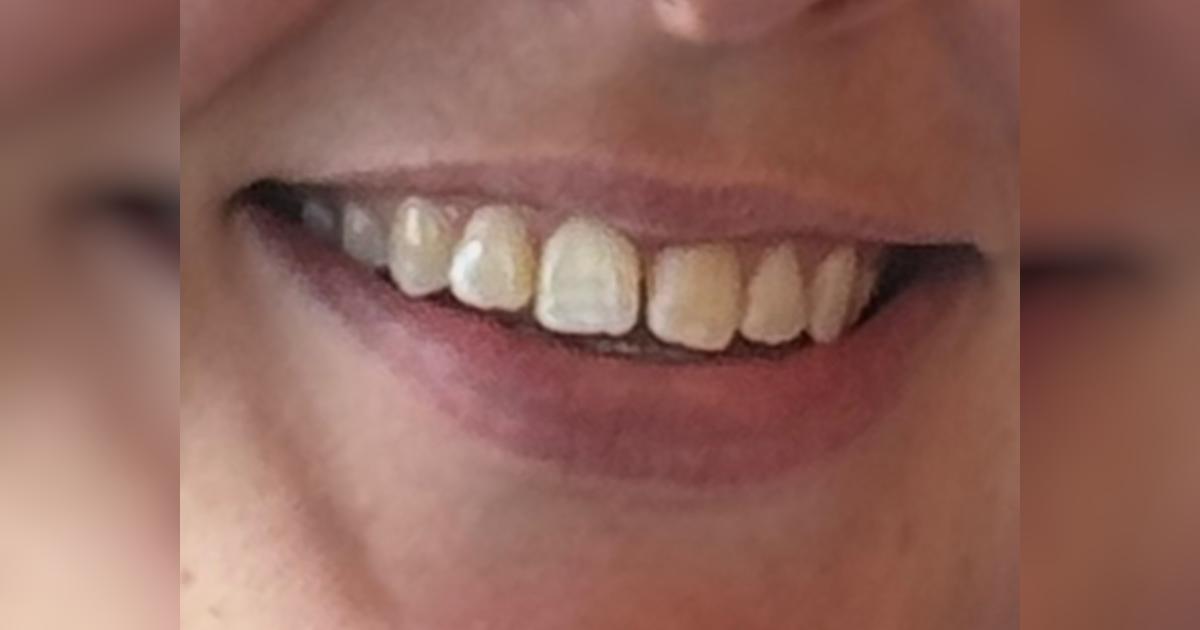 Straight Teeth for the First Time EVER? - Givealittle