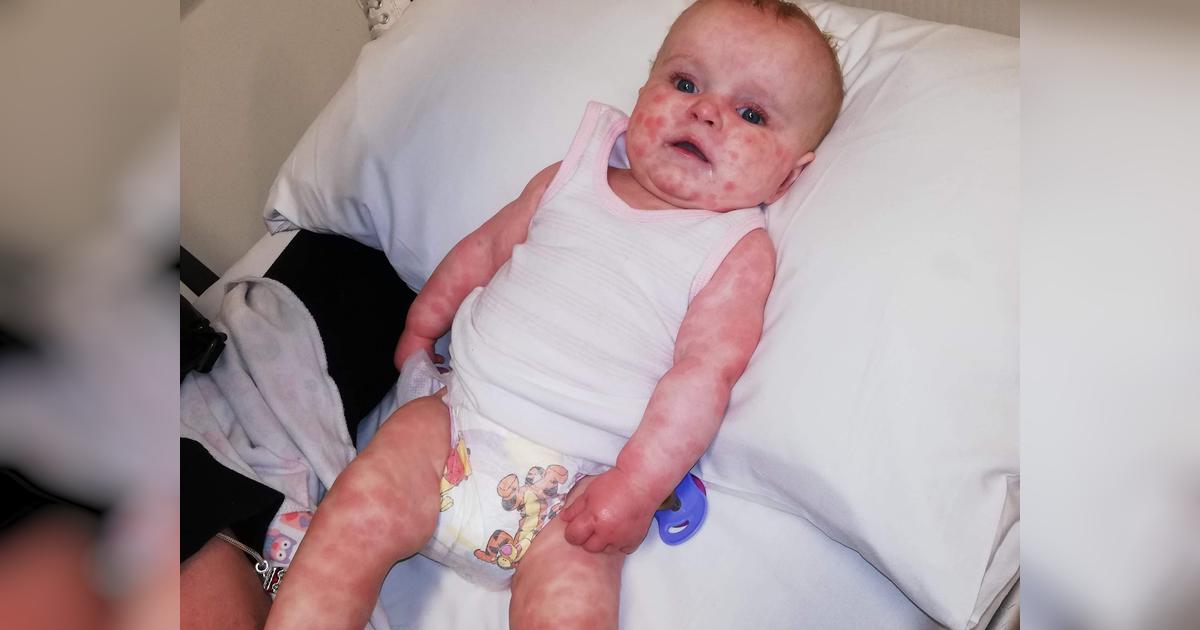 Baby Harper needs your help to fight this rare disease, NOMID (Neo ...