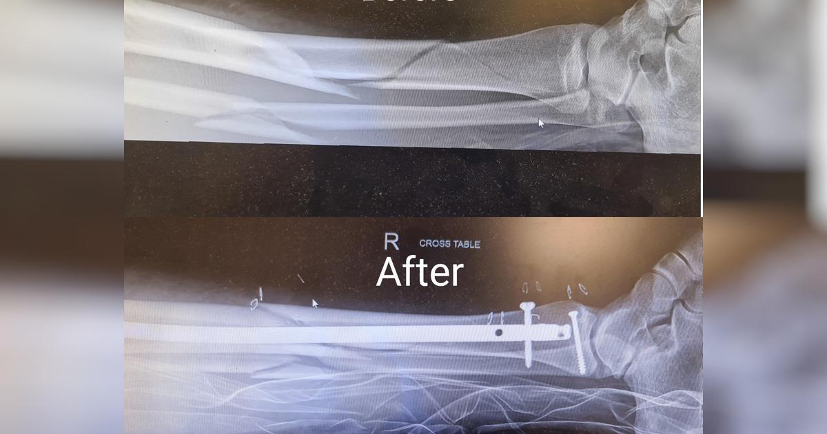 One Step at a Time: Supporting My Broken Leg Healing with Donations ...