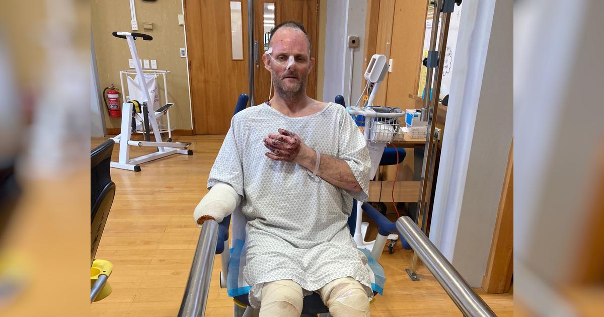Burns victim from Electric Scooter explosion - Givealittle