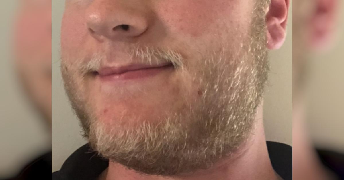 Tom's poor attempt at growing facial hair - Givealittle