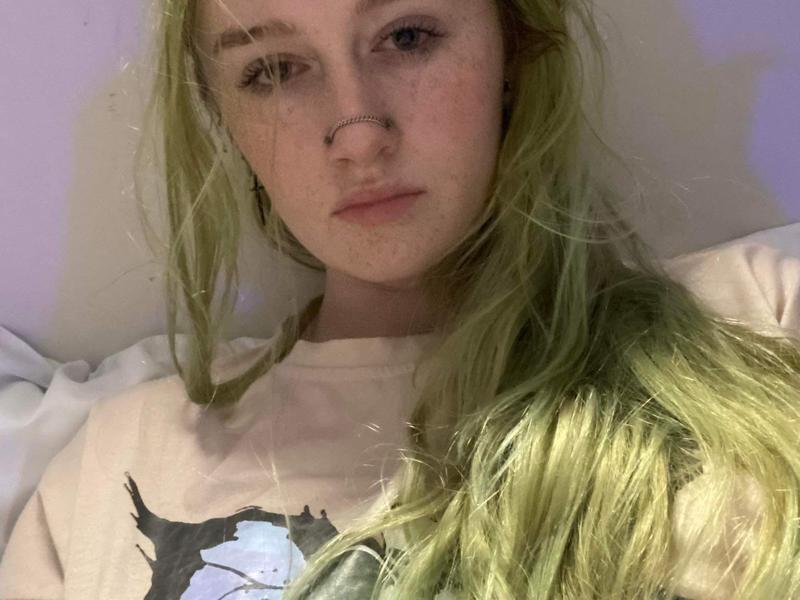 Diagnosed Ehlers Danlos Syndrome now Life threatening vascular ...