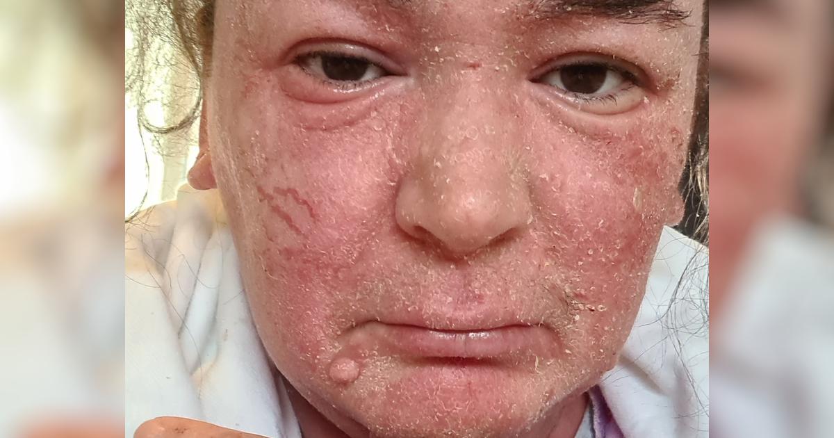 Topical Steroid Withdrawal and severe Atopic Dermatitis - A lifetime of ...