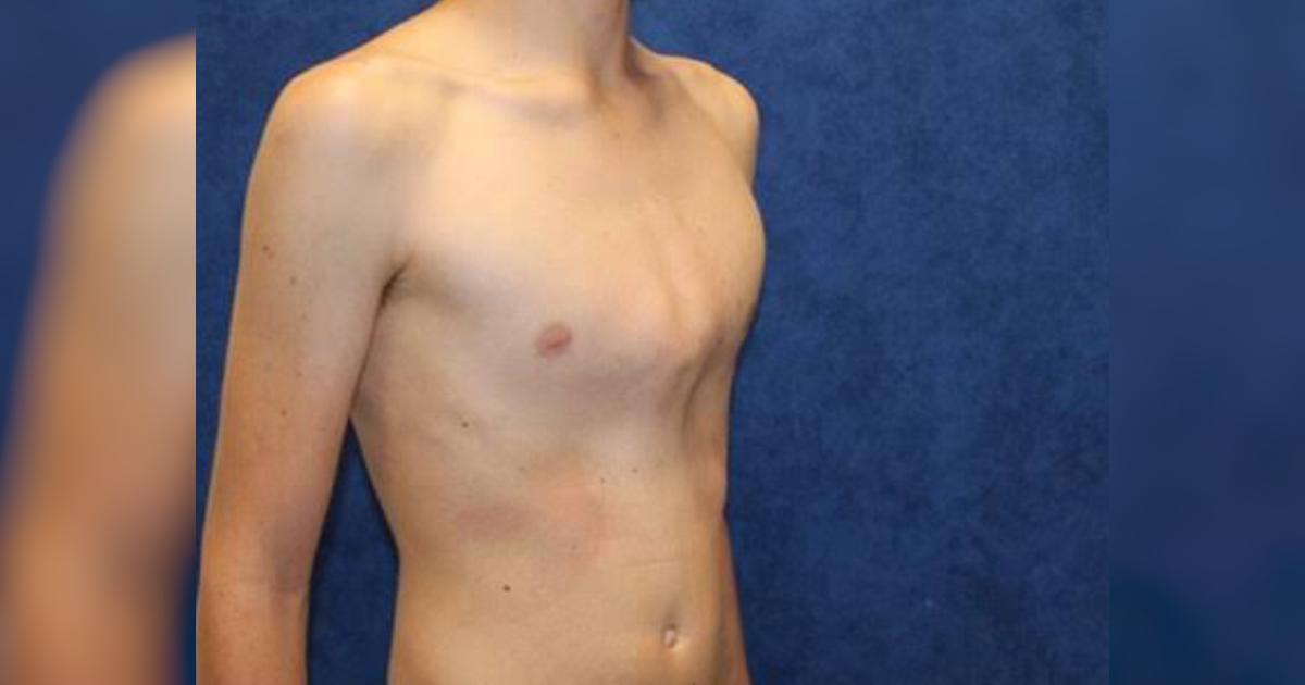 Support Blake with his Pectus Carinatum Surgery - Givealittle