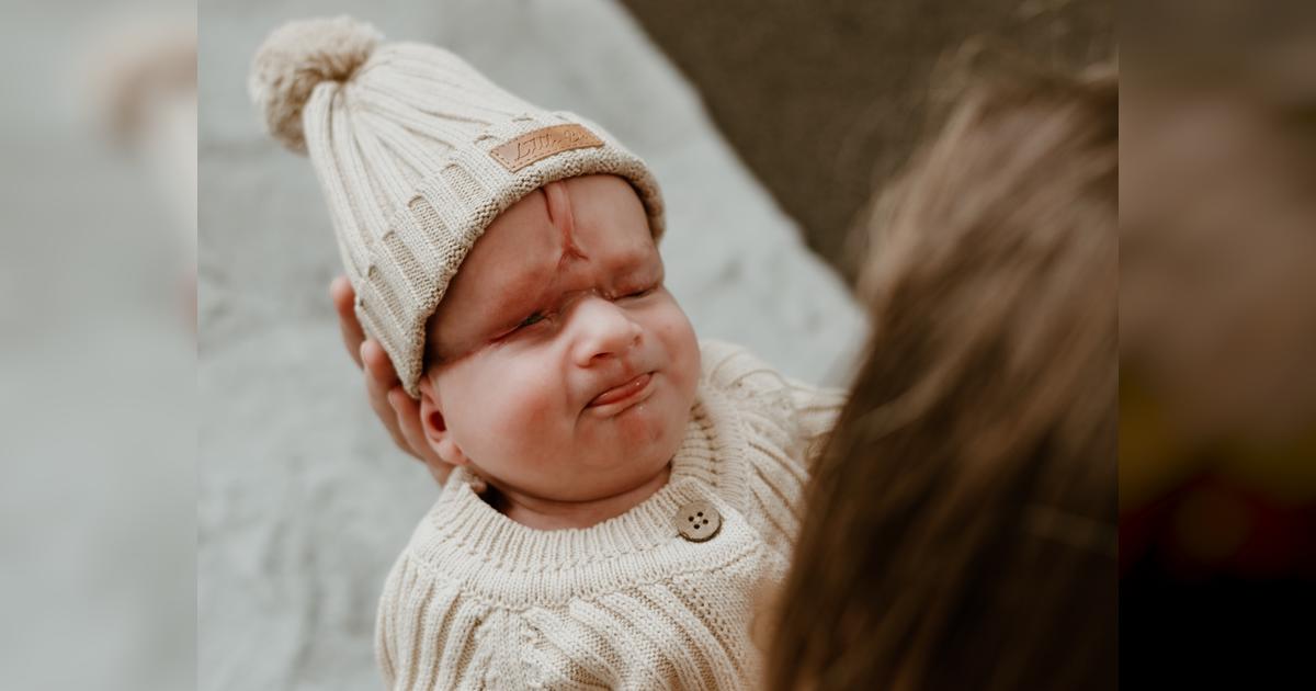 Supporting baby Ollyver, born with rare Amniotic Band Syndrome ...