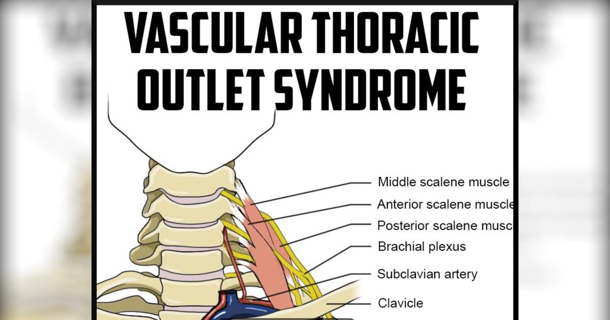 Cervical Rib Removal Surgery for Thoracic Outlet Syndrome - Givealittle
